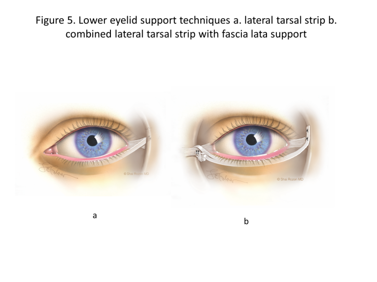 Protection of the Eye in Patients With Facial Paralysis – Part 2 (Eye ...