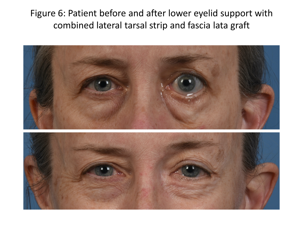 Protection of the Eye in Patients With Facial Paralysis – Part 2 (Eye ...
