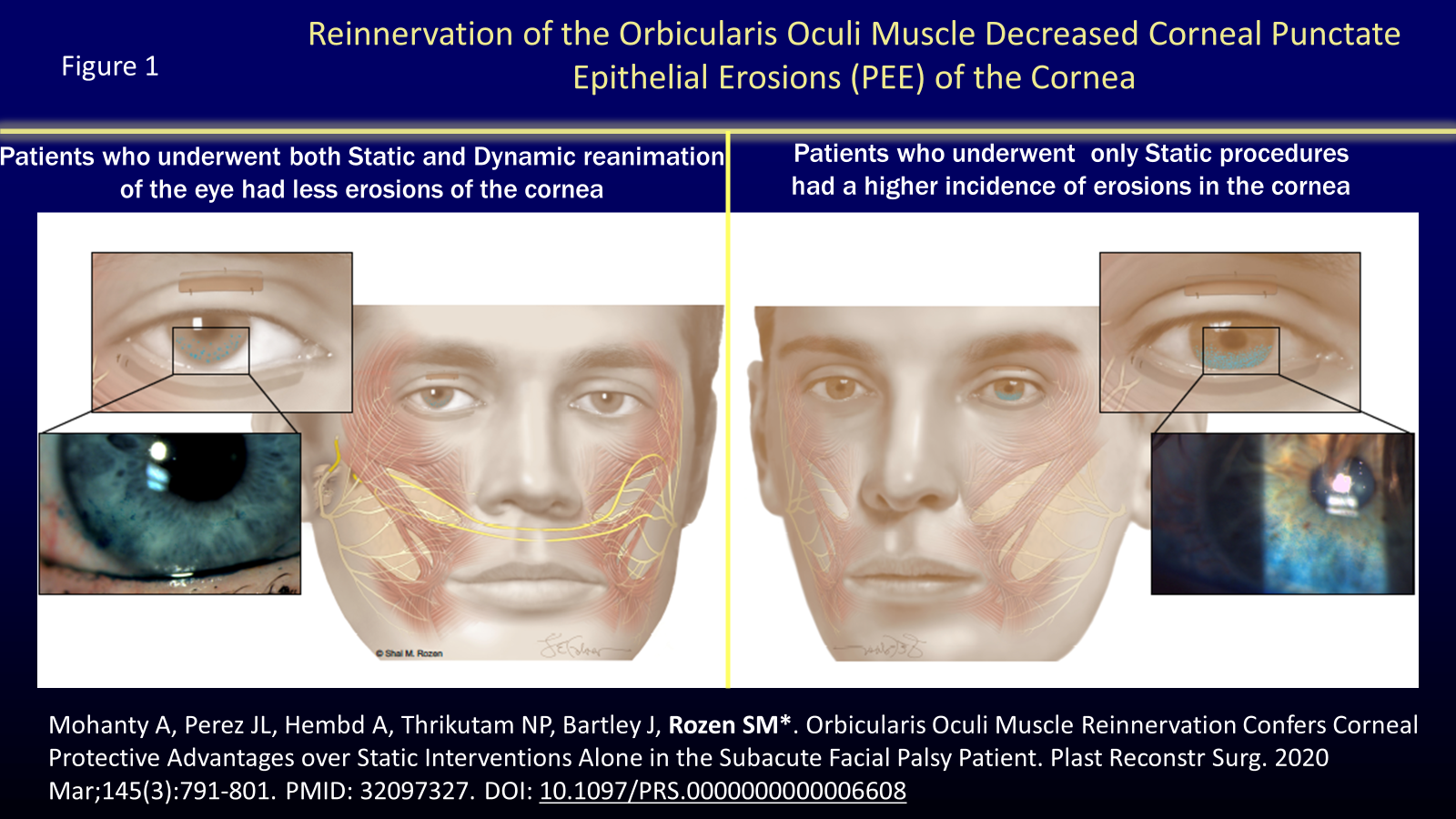 Protection of the Eye in Patients With Facial Paralysis – Part 1 | Shai ...